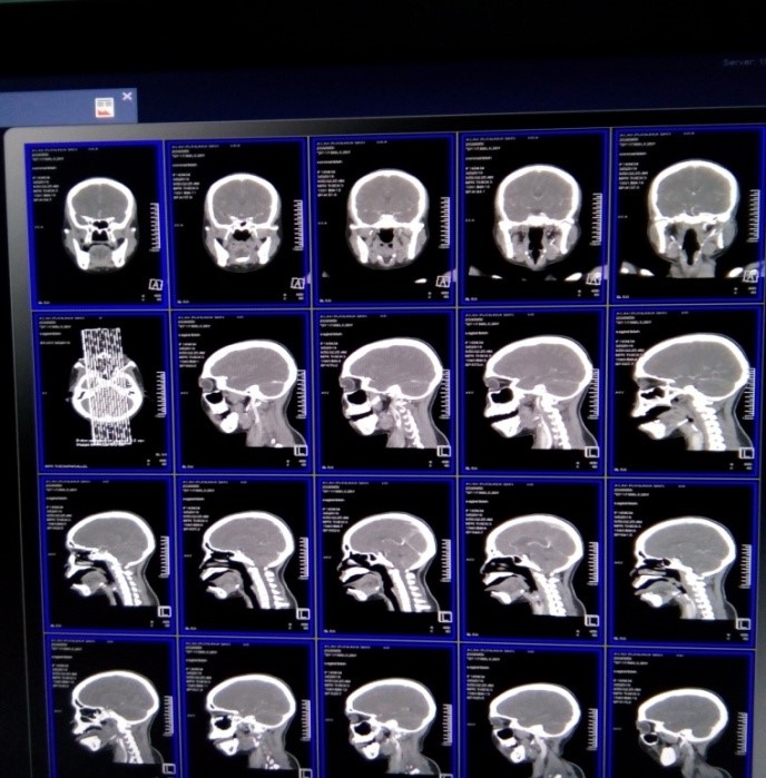 Penatalaksanaan pemeriksaan CT Scan lidah kasus CA lidah - PARI Jakarta ...